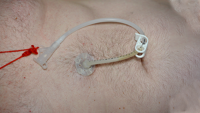 SDB webshop | Gastrostomiekatheter verwisselen en verzorgen